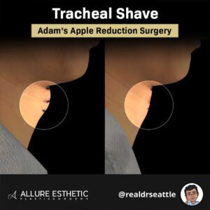 Tracheal Shave Surgery - Adam's Apple Reduction, USA