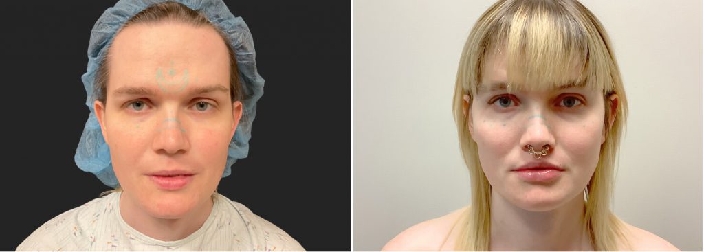 Top Facial Feminization Surgery in Sacramento, CA