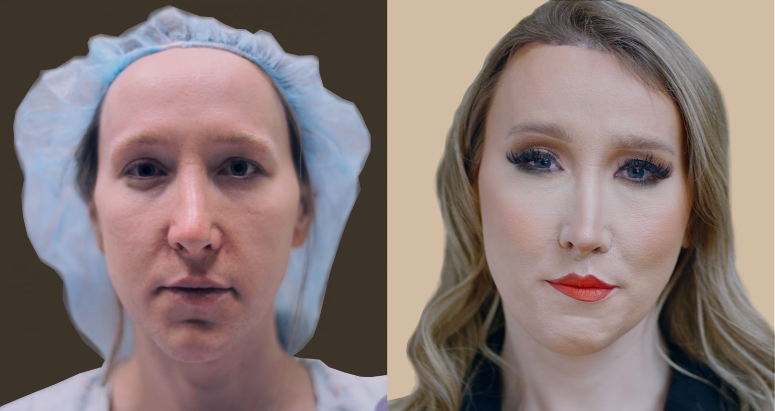 Transform with Transgender Hair Transplant in Alaska | Dr. Javad Sajan