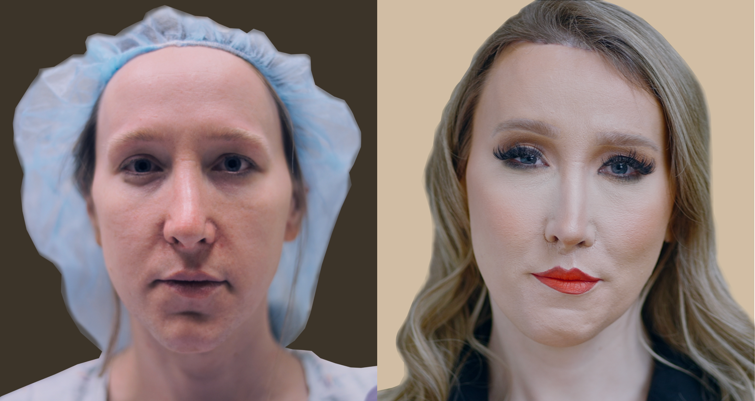 Transform with Transgender Hair Transplant in Alaska | Dr. Javad Sajan
