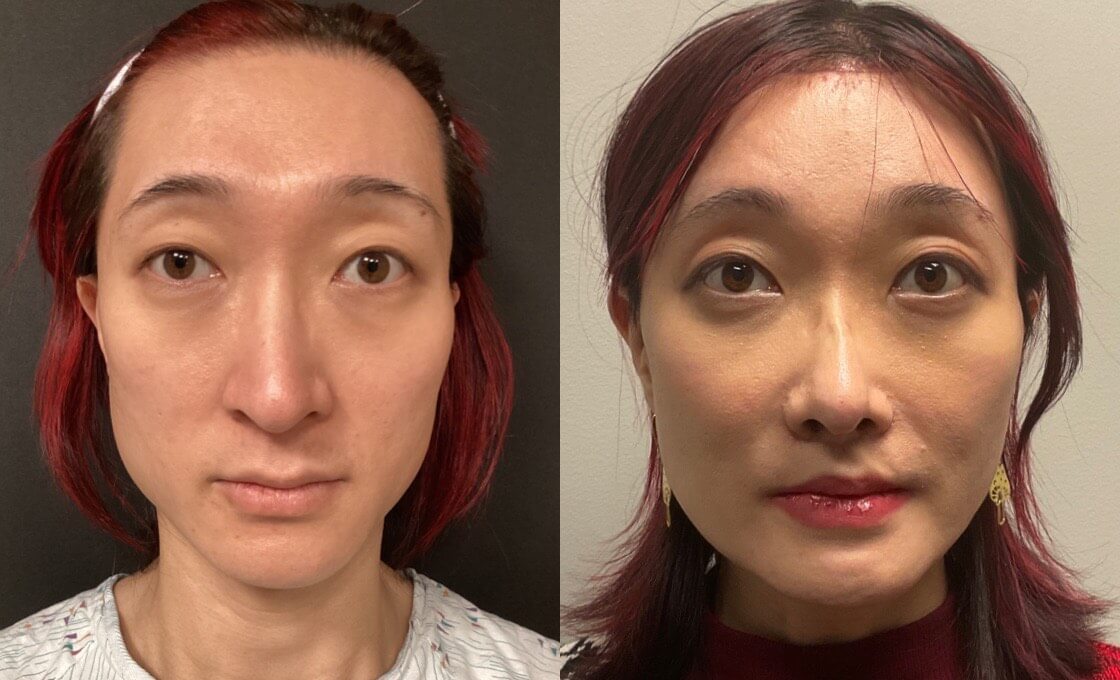 Transgender Hair Transplant in Idaho | Transformative Hair Restoration ID